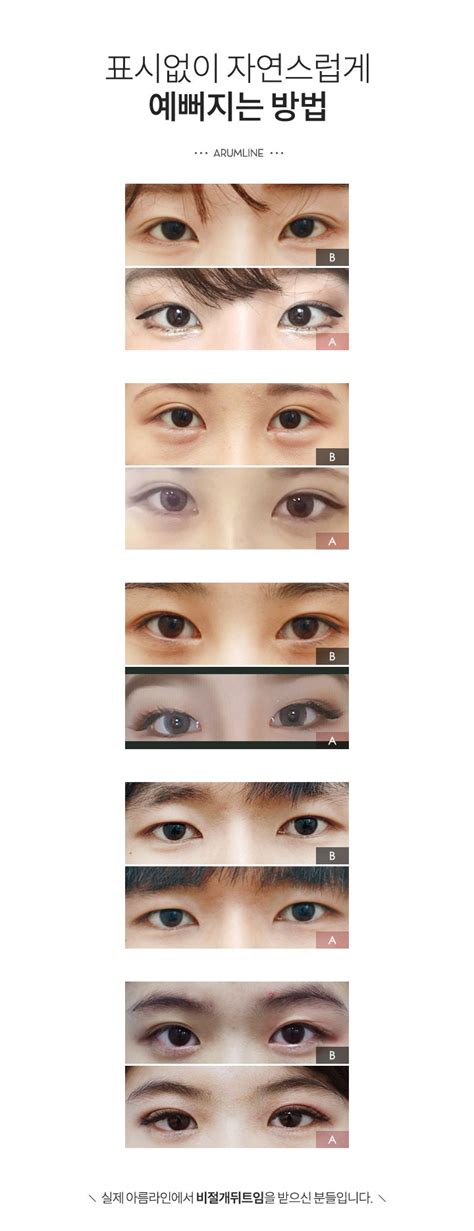 비절개 뒤트임 쌍커풀 자연유착 비절개뒤트임 눈꼬리올림 트임재수술 윗트임 이마거상 미니거상