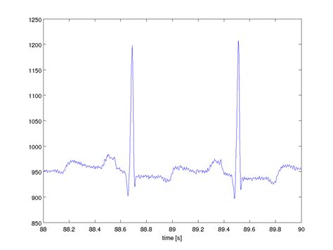 Human Biology Is A Raised Baseline Between T And Qrs Normal In Any Ecg Lead Biology Stack