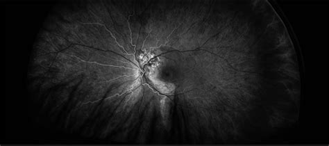Choroidal Hemangioma Retina Image Bank
