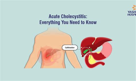 Acute Cholecystitis Ct Findings Of Acute Cholecystitis And Its