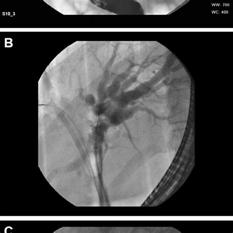 Endoscopic Treatment Of Advanced Portal Cavernoma Cholangiopathy A Download Scientific
