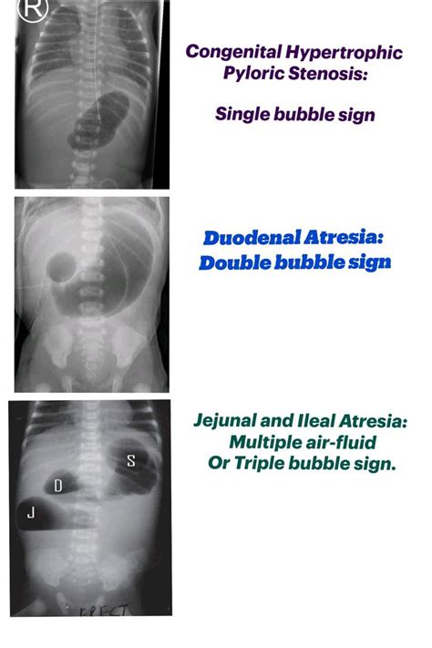 Single Bubble Double Bubble And Triple Bubble Sign In Gi Radiology In