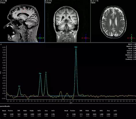 Philips Spectroscopy Brain Mr Clinical Application Philips