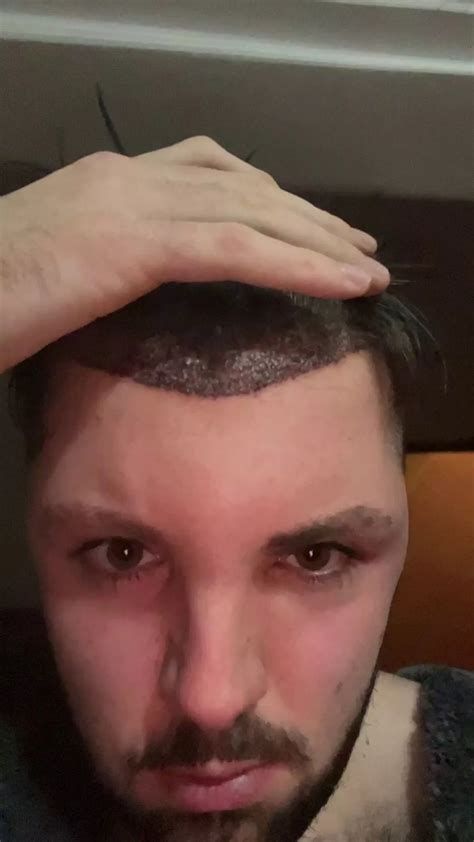 Man Ignores No Sex Advice After Hair Transplant And Soon Pays The Price The Mirror