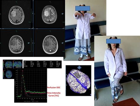 Years Old Female Patient Fibrillary Astrocytoma Grade II Of The Download Scientific Diagram