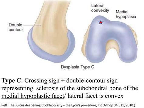 Trochlear Dysplasia Pptx