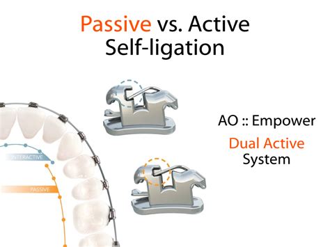 Active Versus Passive Self Ligation Control Versus Low Friciton