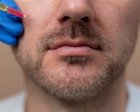 Beard Alopecia Causes And Treatment