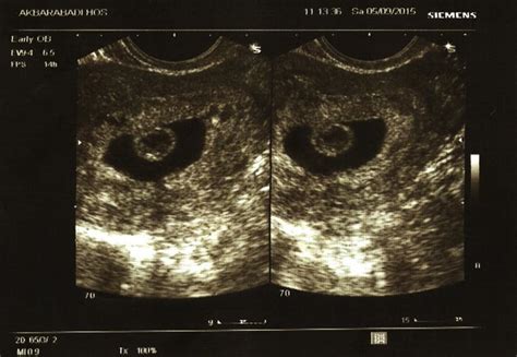 Transvaginal Image Of A Chorionic Bump Age Of Gestation 7 Weeks 1 Download Scientific