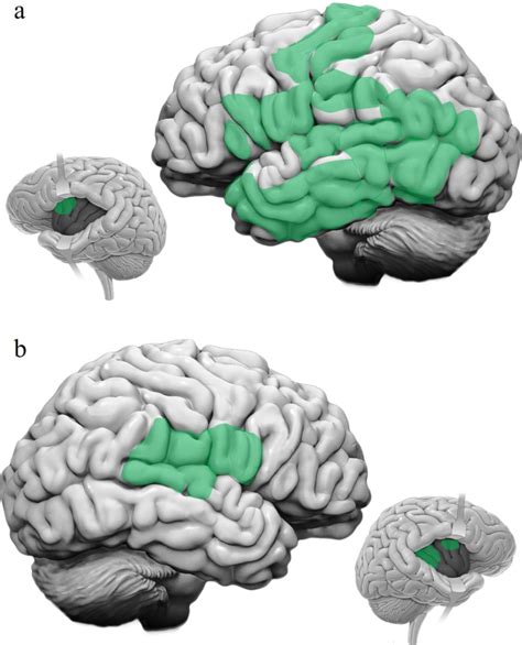 Awake Surgery With Mapping Based Resection To Treat Focal Epilepsy In Eloquent Brain Areas