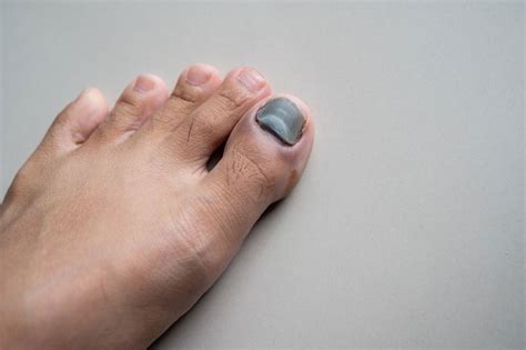 Seven Weird Reactions You Get To Exercise From Bleeding To Black Nails