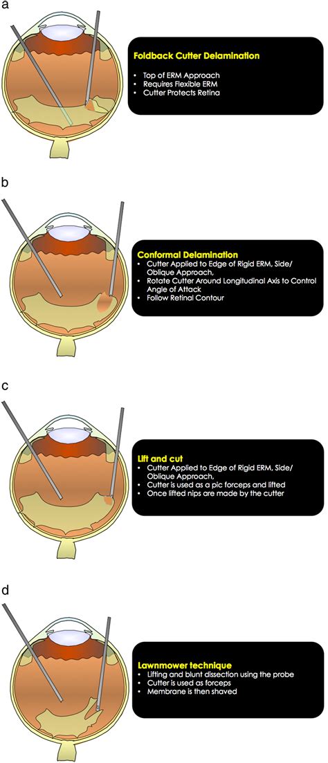 Vitrectomy Cpt