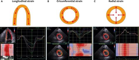 Two Dimensional Echocardiographic Assessment Of Myocardial Strain