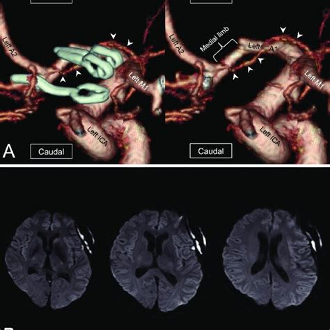 Postoperative Three Dimensional Rotational Angiography 3d Ra A And