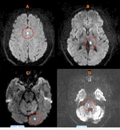 Diffusion Weighted Sequence A D Demonstrating Multiple Foci Of Acute