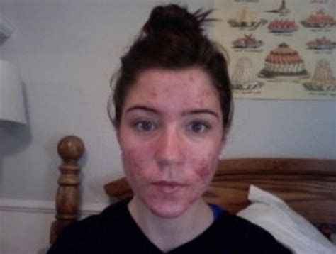 How To Get Rid Of Pimple Scabs