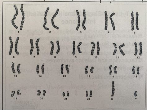 Msud Karyotype Abnormal Male