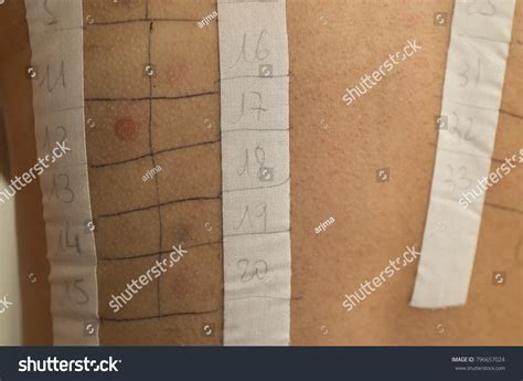 Patch Test Allergic Reaction Allergic Contact Stock Photo Shutterstock