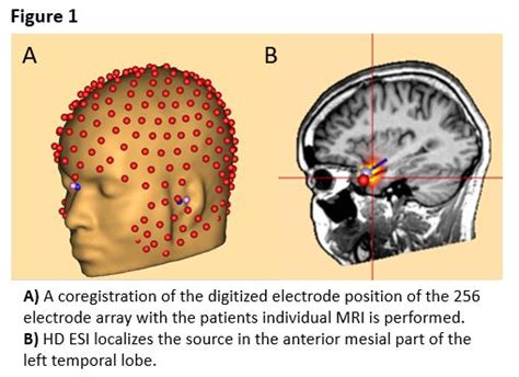 Clinical Utility Of High Versus Low Density Eeg Source Imaging In