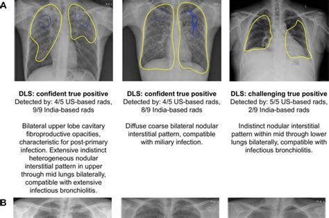 ai based system shows promise in tuberculosis detection hale plus hearty