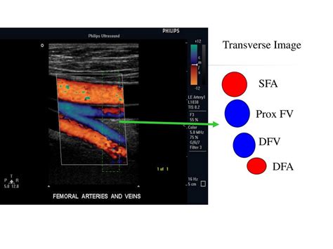 Extremity Arterial Anatomy Ppt Download