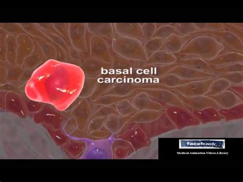 Main Type Of Skin Cancer — Their Differences Histology 40 Off