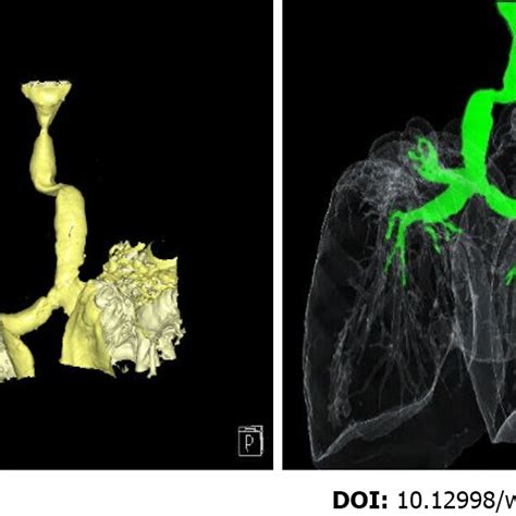 3d Computed Tomography Reconstruction Of The Trachea Download Scientific Diagram