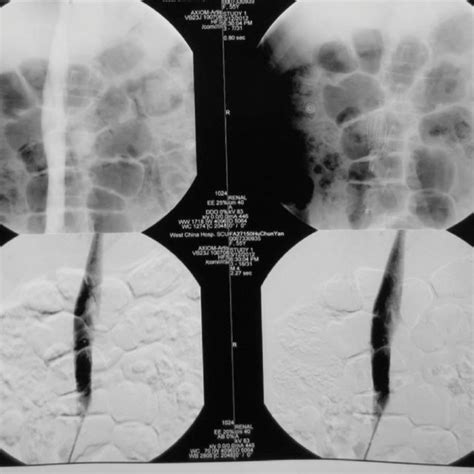 Placement Of Inferior Vena Cava Filter Download Scientific Diagram
