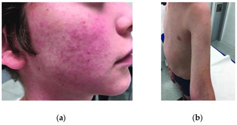 Maculopapular Rash Face