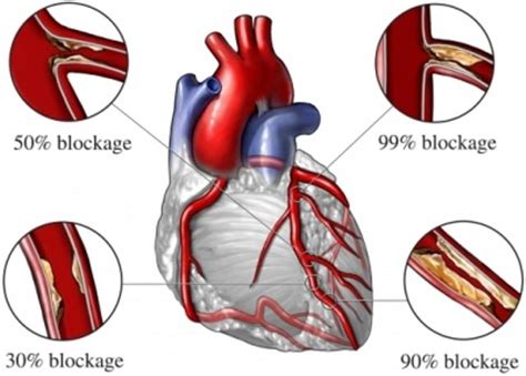 What Causes High Triglycerides What Causes This