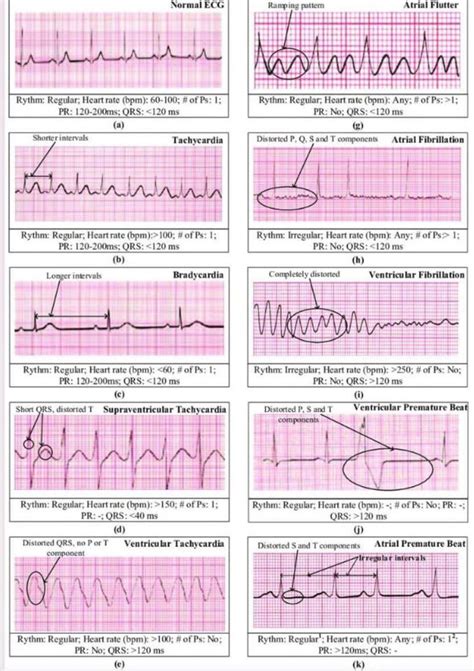 Ecg Normal Vs Anormal How To Read An Ecg Ecg Interpretation Ekg