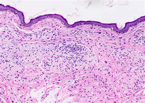 Xanthelasma Vs Xanthoma
