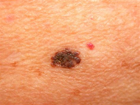 Early Stage Melanoma Skin Cancer Treatment