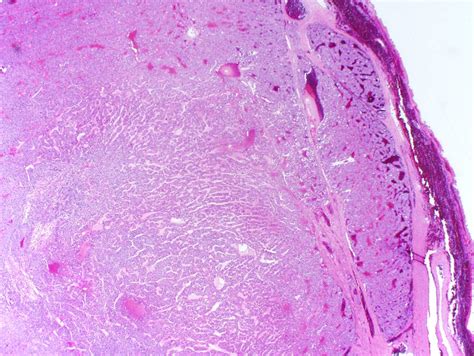 Pathology Outlines Poorly Differentiated Thyroid Carcinoma