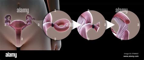 Illustration Showing Tubal Ligation Of The Fallopian Tube By Pomeroy
