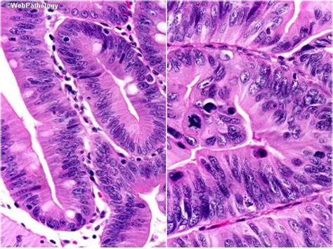 Ampullary Adenoma With High Grade Dysplasia