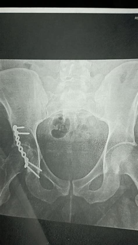 Broke And Dislocated My Hip Falling Off A Semi At Work Rinjuries