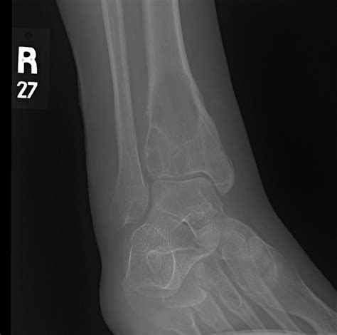 Radiopaedia Case Giant Cell Tumor Distal Tibia Id 16266 Study 115446 Nc Commons Radiopaedia Case Giant Cell Tumor Distal Tibia Id 16266 Study 115446 Nc Commons