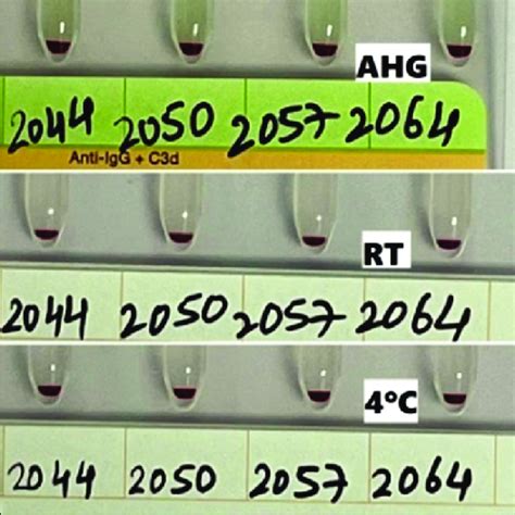 Crossmatches At The Three Phases Anti Human Globulin Room Temperature Download Scientific