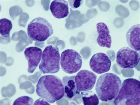 Leukemia Lymphoma And Multiple Myeloma Franciscan Health
