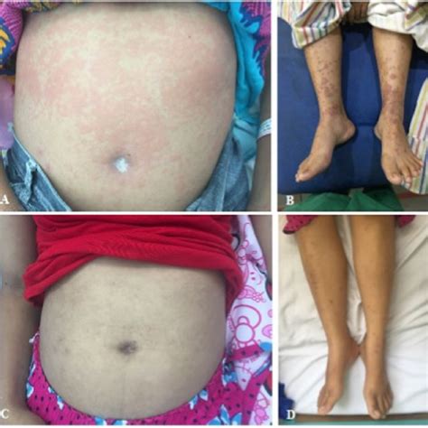 The Diffuse Maculopapular Rash Was Observed On The Abdomen And Lower