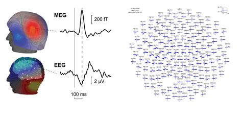 Cerebral Imaging Meg Overview