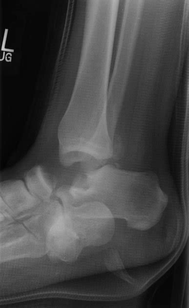 Complete Talar Dislocation Buyxraysonline