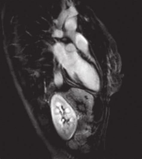 Mri Global Left Ventricular Hypokinesis With Depressed Ejection Download Scientific Diagram
