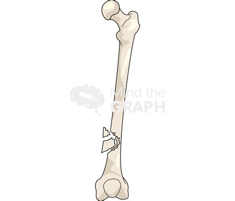 Free Comminuted Femur Fracture Icons Symbols Pictures And Images Mind The Graph