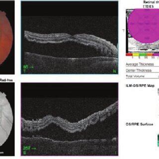 OCT Scan Of The Right Eye Showing Exudative Retinal Detachment Prior To Download Scientific