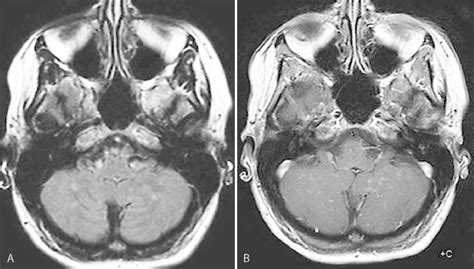 Axial Flair Image A Multiple Punctate And Linear Flair Hyperintense Download Scientific