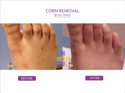 Corn Removal In Gurgaon And South Delhi Saket Royal Lush