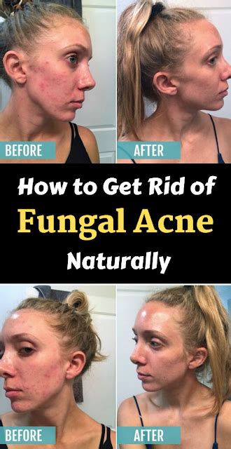 How To Get Rid Of Fungal Acne Naturally Healthy Lifestyle