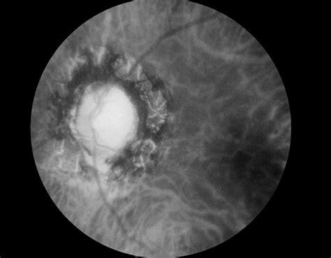 Ocular Syphilis May Be Overlooked When Presenting As Inflammation Ophthalmology Advisor